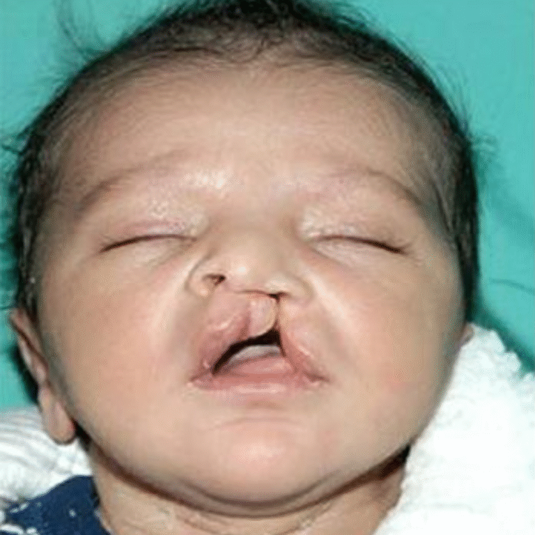 Cleft Surgery – astheticplasticsurgery.com